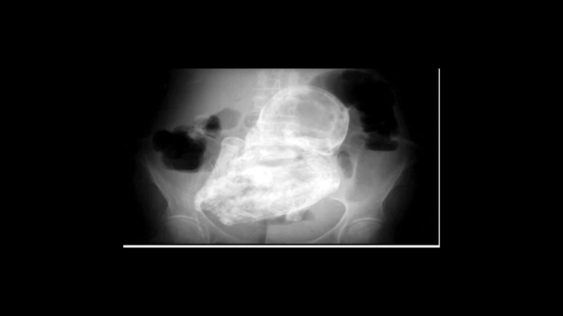 40-Year-Old Calcified Fetus Found In Columbian Woman | wfmynews2.com