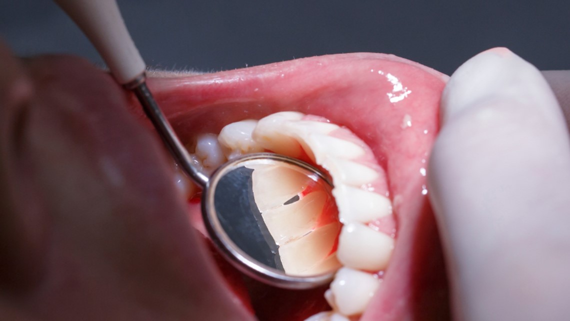 Keep your teeth clean and cavity free | wfmynews2.com