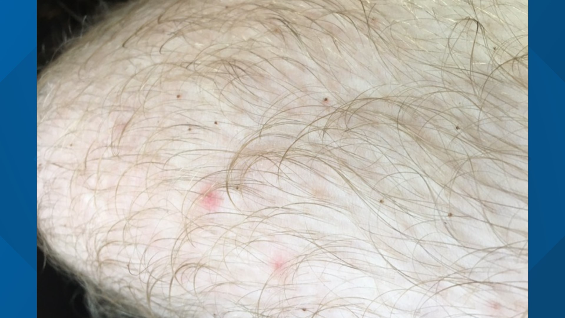 Do You Know What A Seed Tick Bite Looks Like? Check It Out! | wfmynews2.com