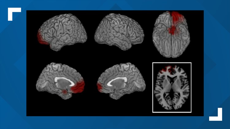 What is EMDR therapy and does it work? | wfmynews2.com