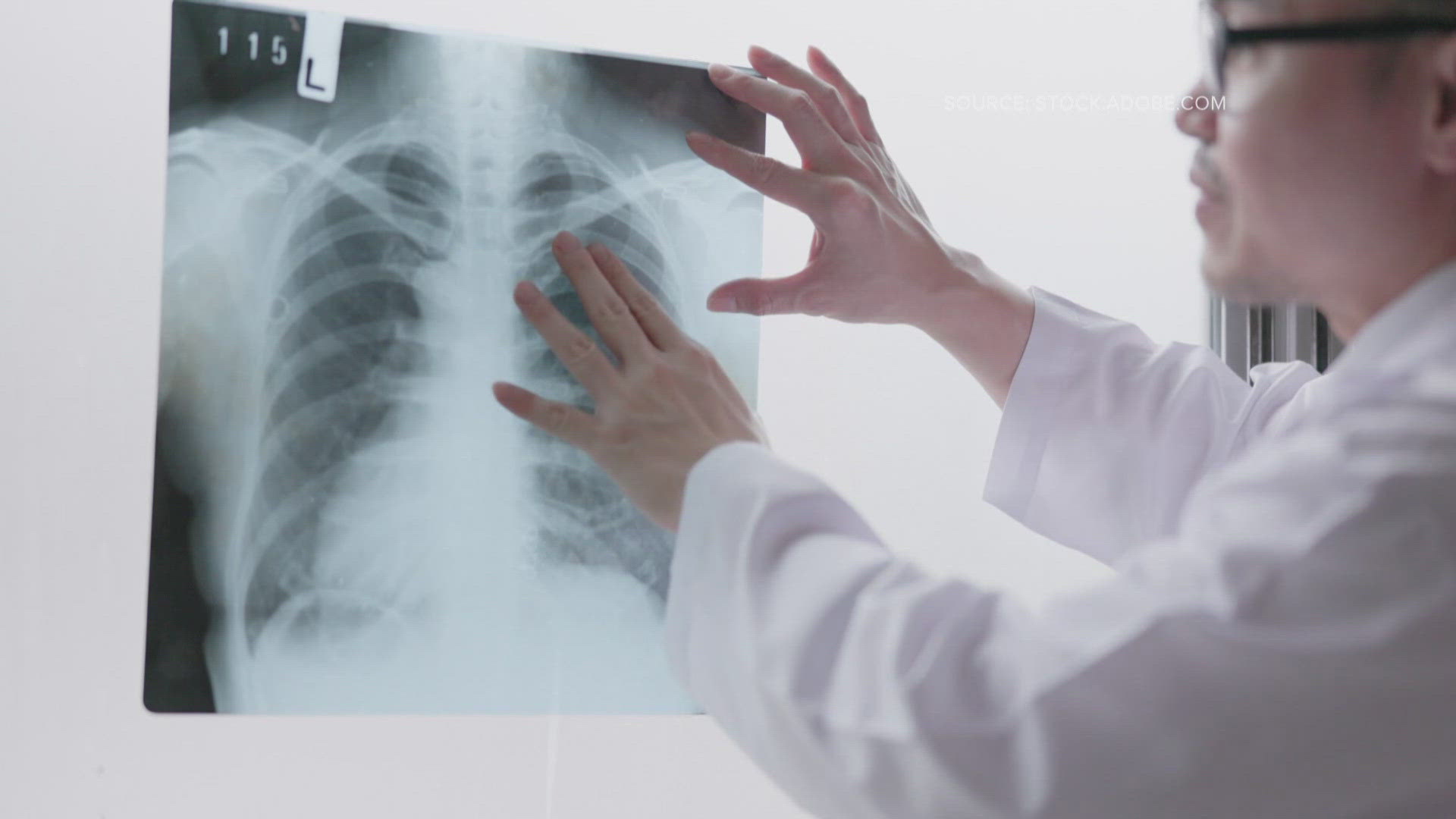 Man diagnosed with lung cancer despite never smoking | wfmynews2.com