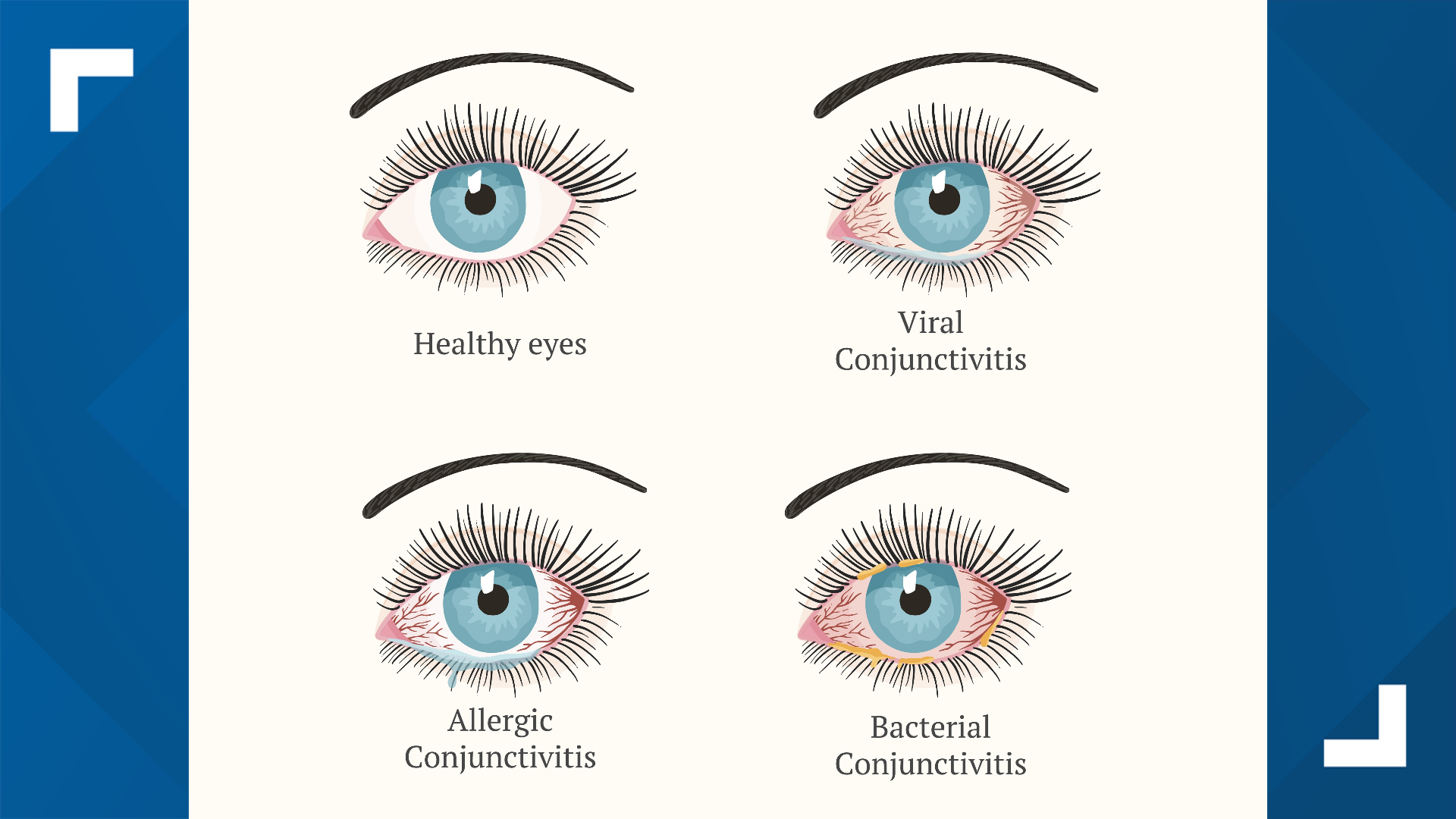 Doctors seeing an uptick in highly contagious pink eye cases ...